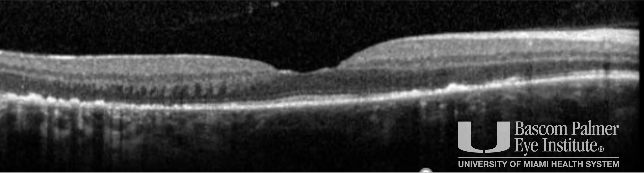 FM050323OI: Fondaparinux Maculopathy | Bascom Palmer